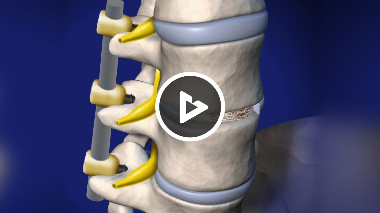 ALIF: Anterior Lumbar Interbody Fusion (with bone graft and pedicle ...