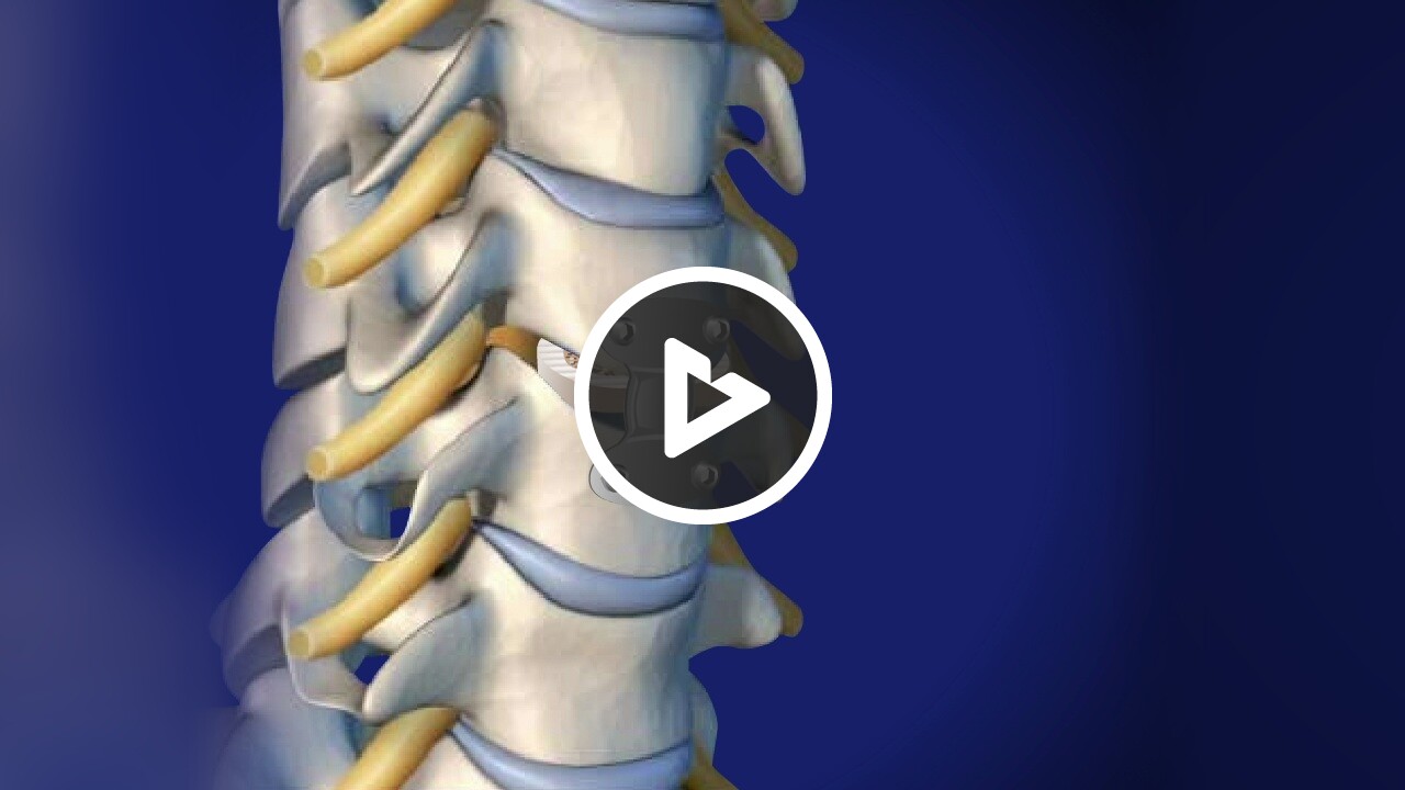 Anterior Cervical Discectomy and Fusion (Intervertebral Spacer ...