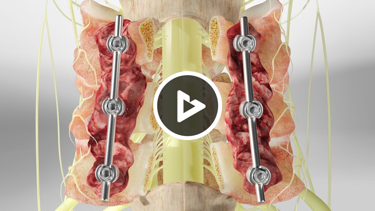 Laminectomy (Cervical Spine, With Fusion) - Treatments - WK Spine ...