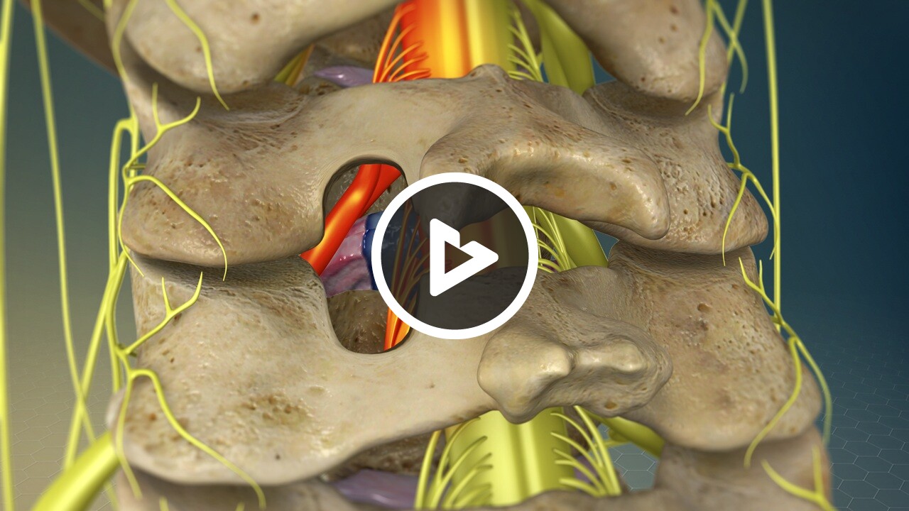 Cervical Posterior Foraminotomy - Treatments - WK Spine Clinic - Spine ...