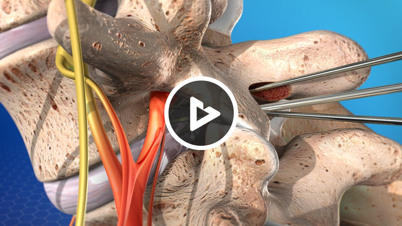 Lumbar Disc Microsurgery - Treatments - WK Spine Clinic - Spine Surgery ...
