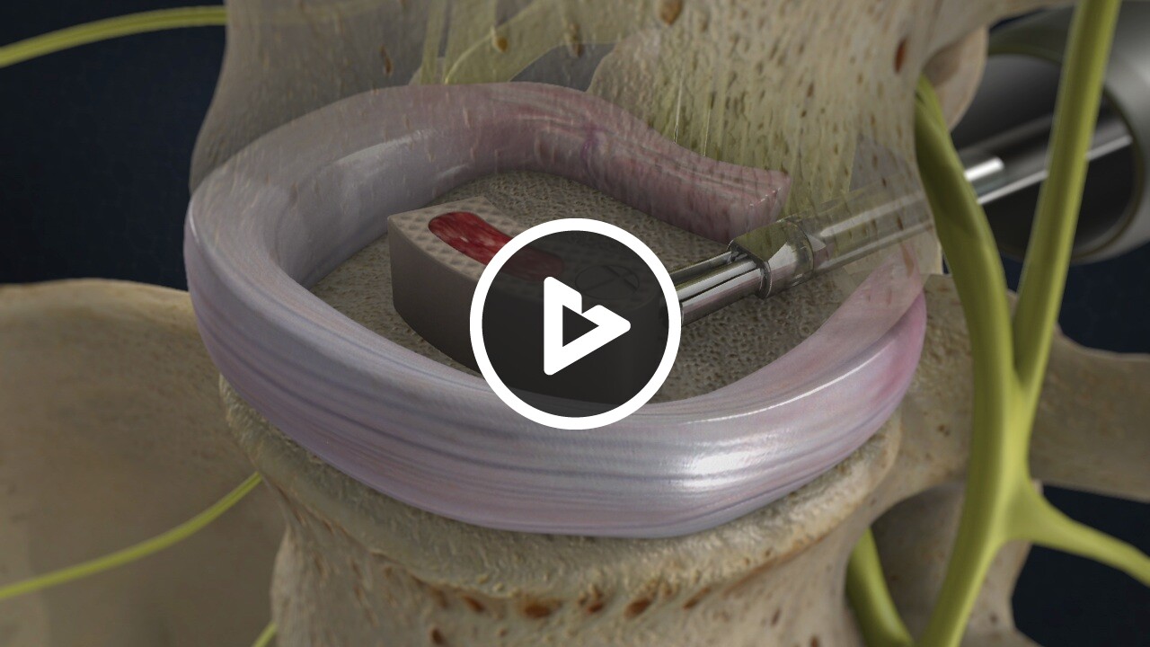 TLIF: Transforaminal Lumbar Interbody Fusion - Treatments - WK Spine ...