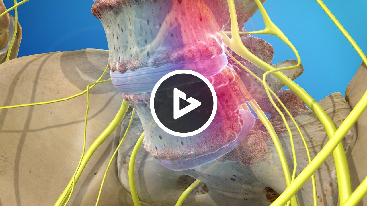 Spondylolisthesis - Conditions - WK Spine Clinic - Spine Surgery ...